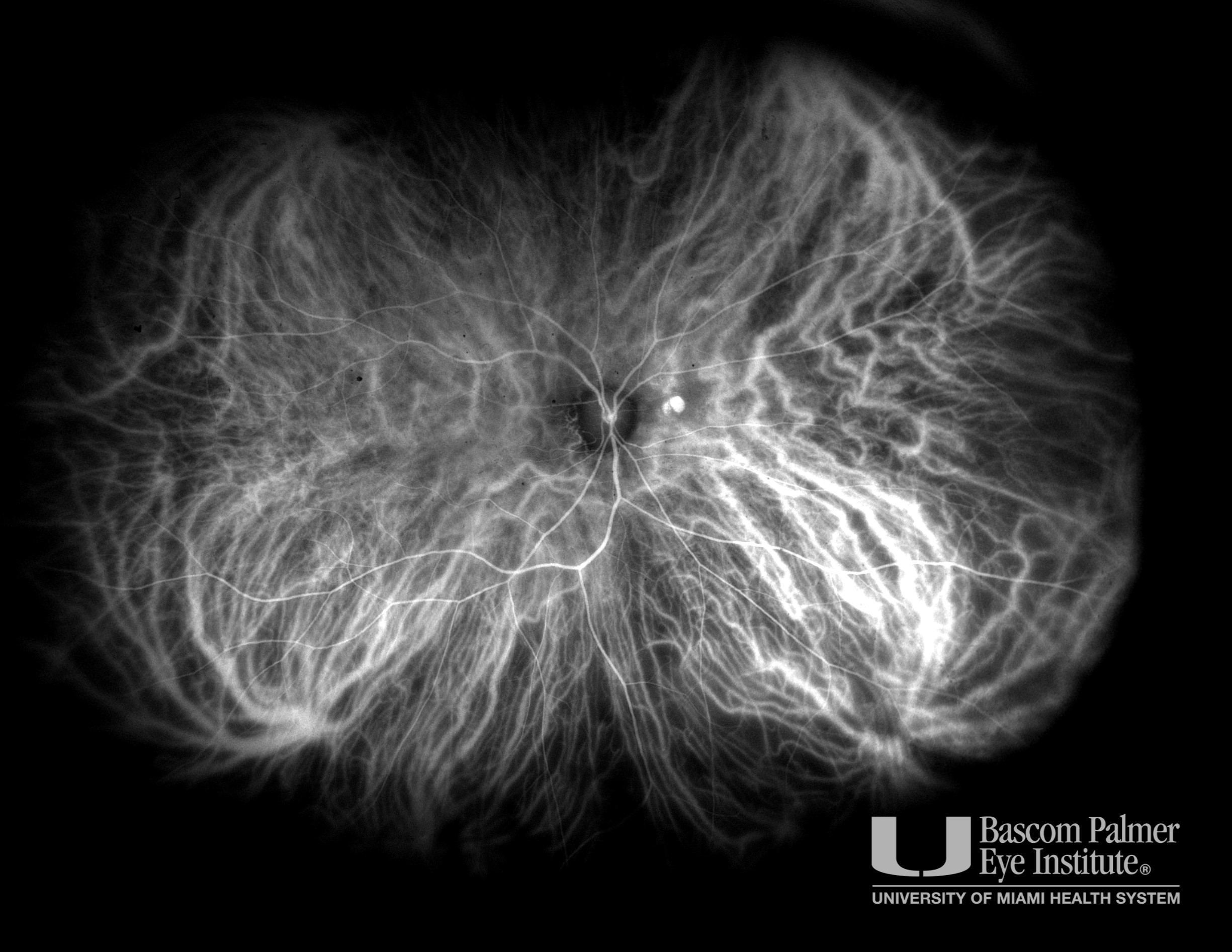 Course: Polypoidal Choroidal Vasculopathy