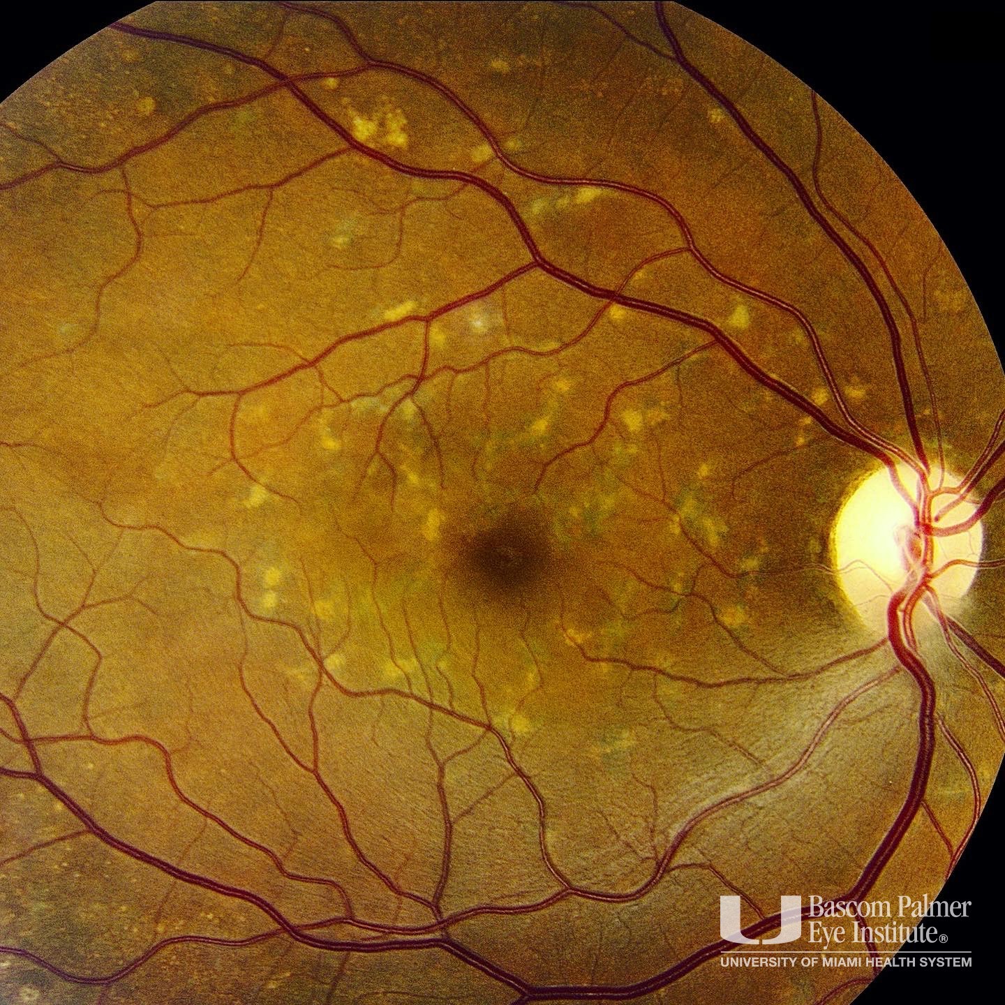 Course: Multifocal Pattern Dystrophy